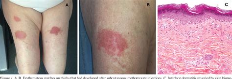 Methotrexate Injection Sites