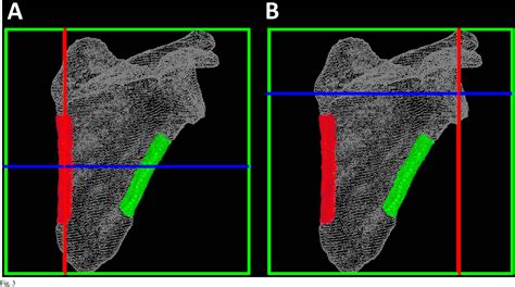 Figure 1 From Three Dimensional Scapular Border Method For Glenoid Version Measurements