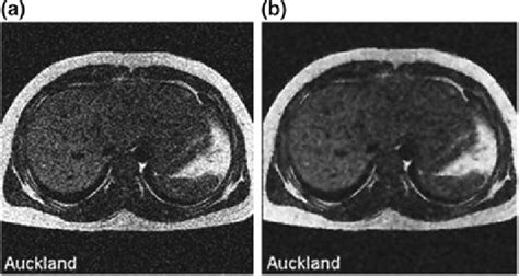 A Salt And Pepper Noise And B Filtered Image [3] Download Scientific Diagram