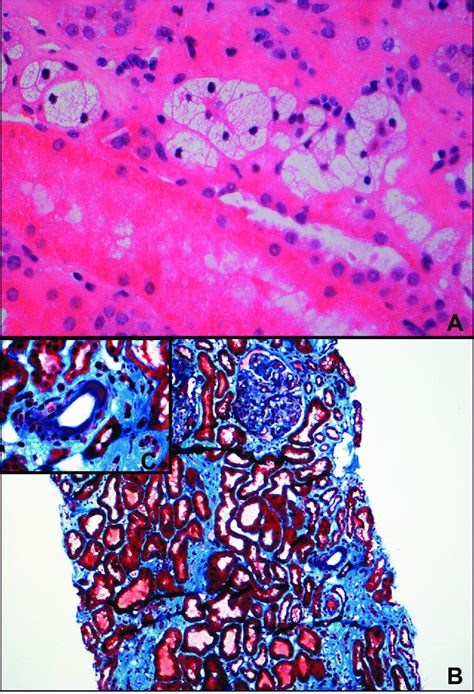 Csa Related Nephrotoxicity A Acute Csa Toxicity Evidenced By