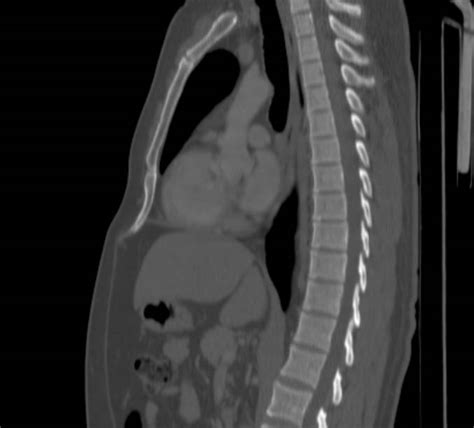 Floating Xiphoid Process At Mary Lakes Blog