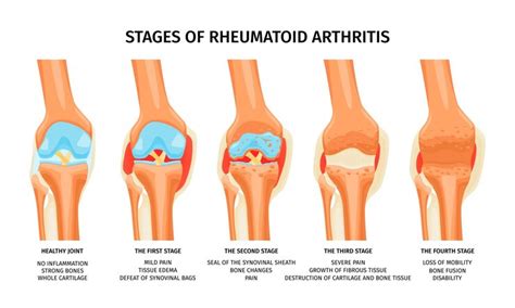 What Are The Stages Of Arthritis Posture Pain Correction