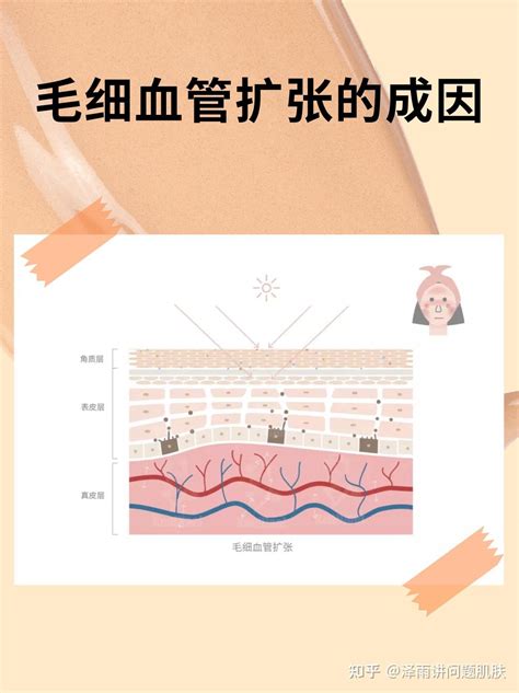 毛细血管扩张（红血丝）的7条成因 知乎