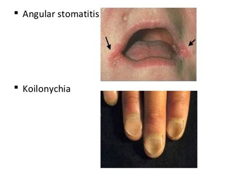 Iron Deficiency Anemia
