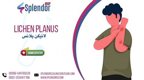 Homeopathic Medicine For Lichen Planus Treatment