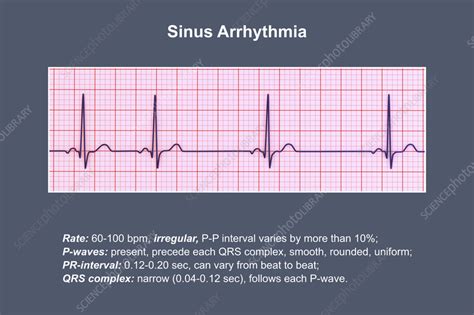 Sinus Arrhythmia Heartbeat Rhythm Illustration Stock Image F0385910 Science Photo Library Sinus Arrhythmia Heartbeat Rhythm Illustration Stock Image F0385910 Science Photo Library