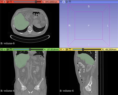 Software To Visualizeannotate Dicomnifti Files Pycad Your Medical Imaging Partner