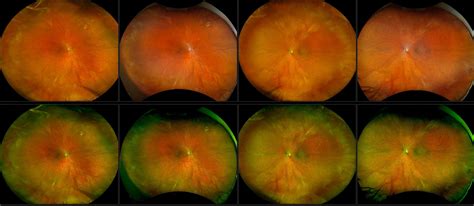 California Lattice Degeneration Montage Rg Rgb