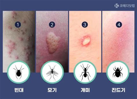 “빈대가 돌아왔다 ” 예방 및 대처법