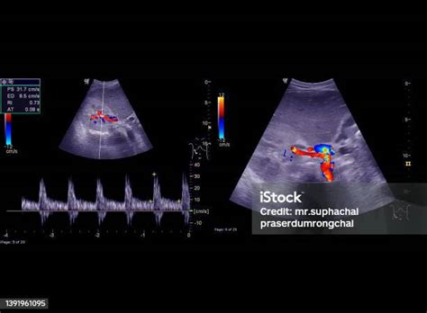사용 후 일반적인 담관에서 흐름을 보여주는 초음파 상부 복부 색상 도플러 초음파에 대한 스톡 사진 및 기타 이미지 초음파