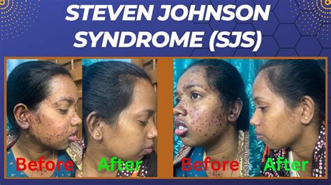 Stevens Johnson Syndrome Sjs Ten Skin Side Effects Of Medicine