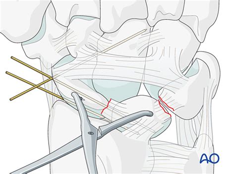 Open Reduction Ligament Repair For Lunate Dislocation