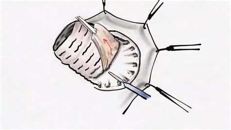 Rectal Prolapse Delorme Procedure Youtube