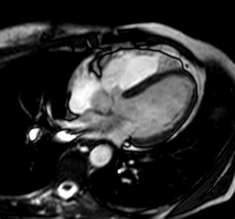 121h Small Membranous Vsd Heart