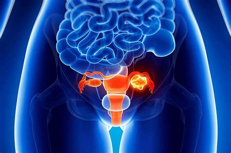 Urologic Cancer Doctor Polk County