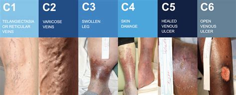 Chronic Venous Insufficiency — Cardiology Institute