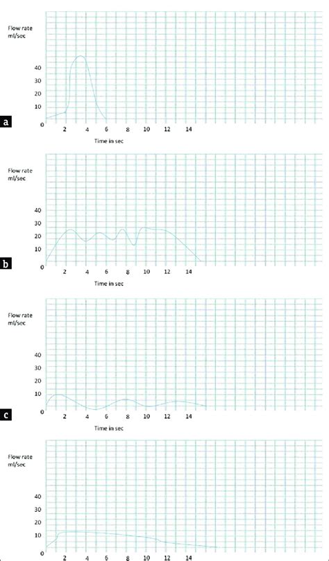 Graphic Representation Of Various Uroflow Patterns A Superflow