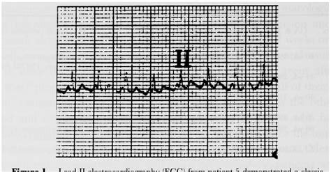Figure 3 From Atrial Flutter In The Neonate And Early Infancy Semantic Scholar