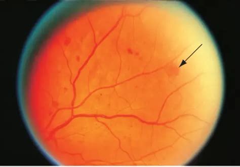 Neovascularization Elsewhere