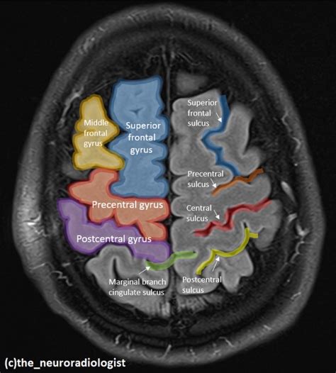 Brain Gyrus Labeled Mri At Layla Lesina Blog