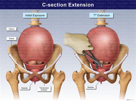 C Section Extension TrialQuest Inc