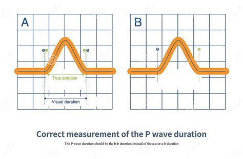 Correct Measurement Of The P Wave Duration Stock Illustration