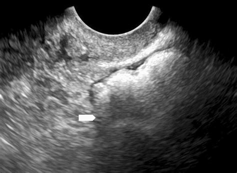 Ultrasound Example Of Bowel Grayscale Transvaginal Ultrasound Image Of