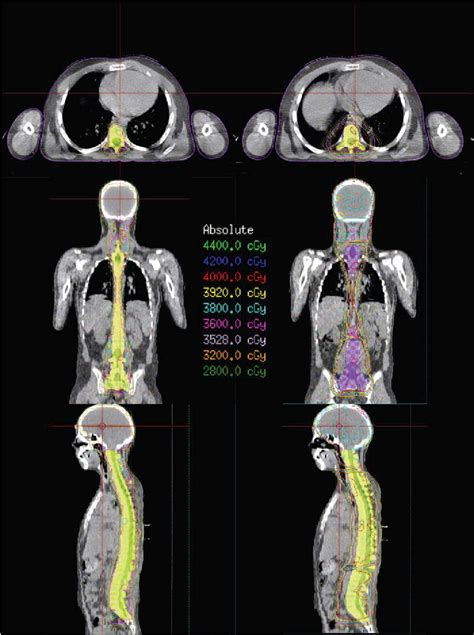 Figure 2 From Comparison Of The Helical Tomotherapy And Mlc Based Imrt