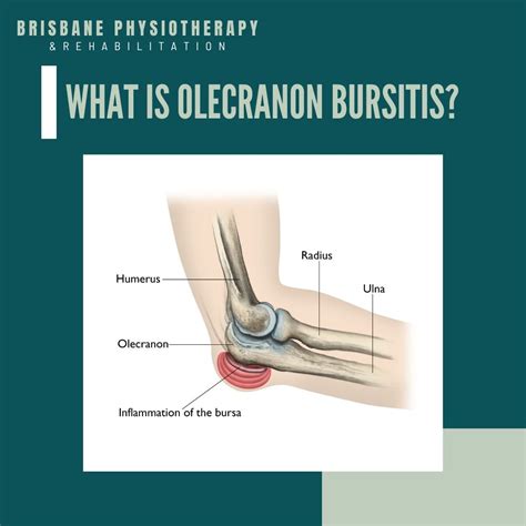 Olecranon Bursitis What Is It And How To Treat It Brisbane Physiotherapy And Podiatry