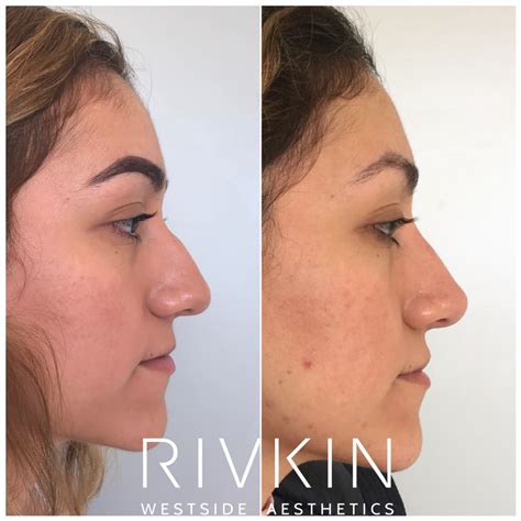 Dr Rivkins Non Surgical Nose Job