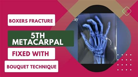 Boxers Fracture 5th Metacarpal Fixed With Bouquet Technique With Retrograde K Wires In A Young