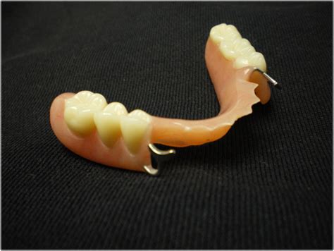 Unilateral Removable Partial Denture