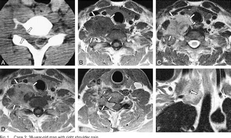 Figure 1 From Spinal Epidural Extraskeletal Ewing Sarcoma Mr Findings In Two Cases Semantic