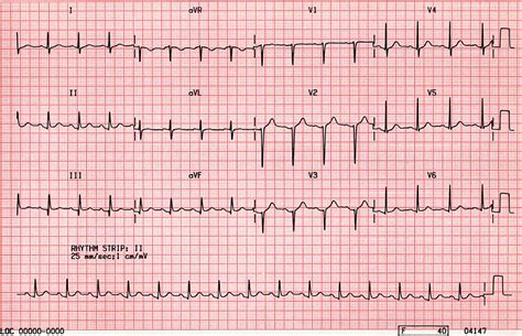 Infarction Ekg Septal Infarct
