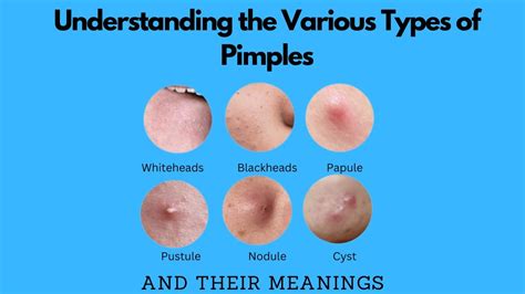 Understanding The Various Types Of Pimples And Their Meanings Youtube