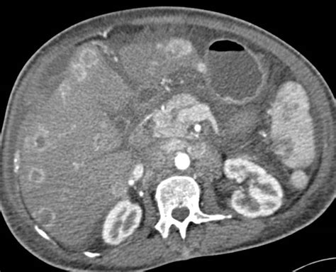 Cholangiocarcinoma Ct