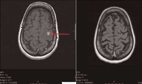 Small Cell Lung Cancer With Mets To Brain Cancerwalls