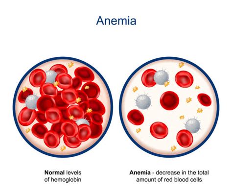 5700 Anemia Stock Illustrations Royalty Free Vector Graphics And Clip