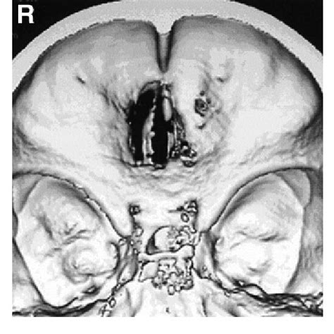 Three Dimensional Computed Tomography Scan Showing The Bony Defect At Download Scientific
