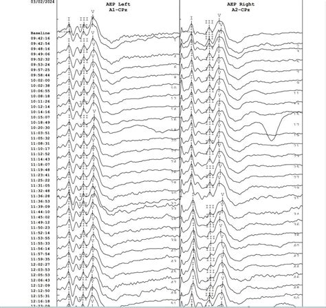 Syed Ahmed Uddin Imran Bsc Reegt Cnim On Linkedin Brain Tumour Neuromonitoring Ionm