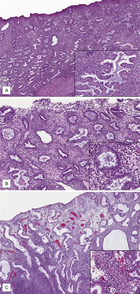 Nonneoplastic Lesions Of The Endometrium Clinical Tree