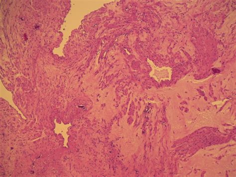 A Suspected Ovarian Cancer In A Postmenopausal Woman That Turned Out To