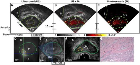 Prostate Anatomy Ultrasound
