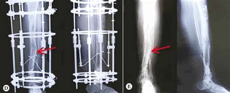 Serial Radiographs Illustrating The Ilizarov Method Using Bone Segment Download Scientific