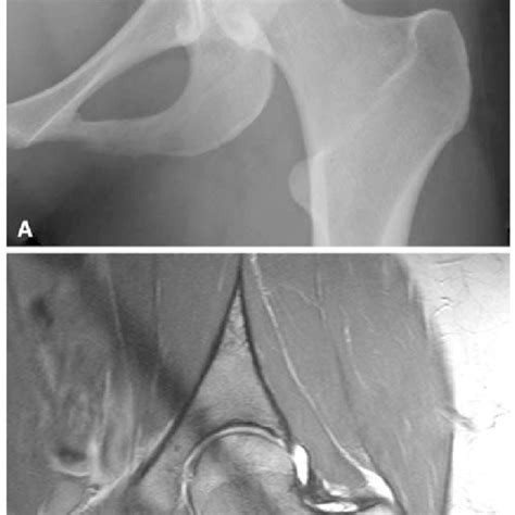 A B A Left Hip From A 23 Year Old Female Patient In The Deep Acetabulum