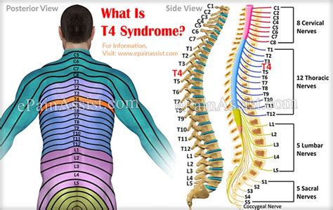 T4 Syndromesignssymptomscausestreatmentrecovery