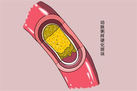 60歲以後查出頸動脈斑塊，現象很常見，做好五件事可以安心 每日頭條