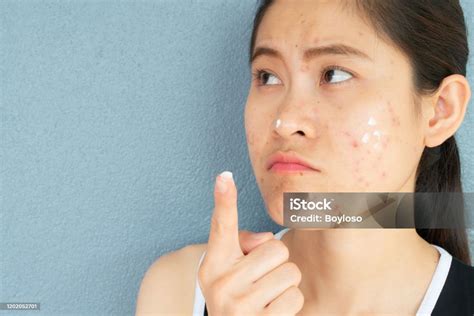 그녀의 얼굴에 여드름 염증 을 가진 여자의 초상화와 그녀는 치료를 위해 그녀의 얼굴에 여드름 크림을 적용 여드름 크림에 대한 스톡 사진 및 기타 이미지 Istock