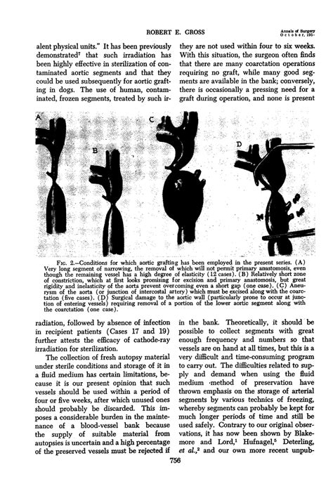 Treatment Of Certain Aortic Coarctations By Homologous Grafts A Report Of Nineteen Cases Pmc