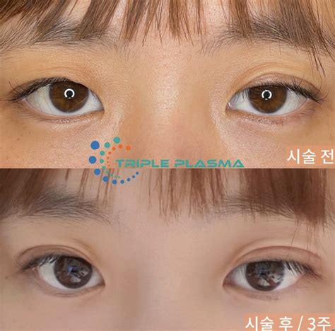 피부학 교수가 알려주는 진짜 플라즈마 콜드플라 부작용 주의사항 가격 효과 및 후기 상안검 하안검 흉터 수술흉터 등등 네이버 블로그